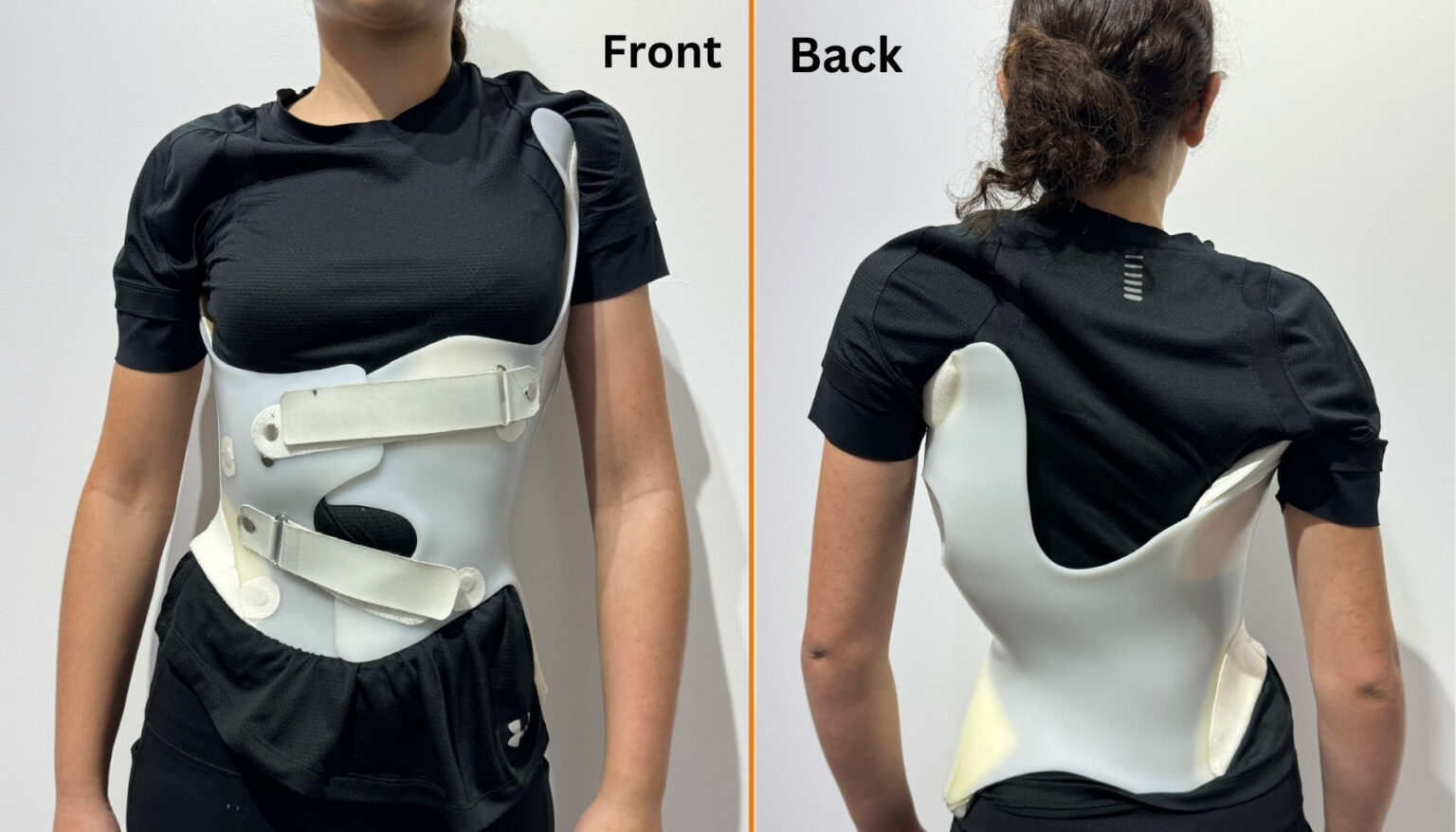 Scoliosis Brace: An Effective, Age-Old Method For Managing Scoliosis